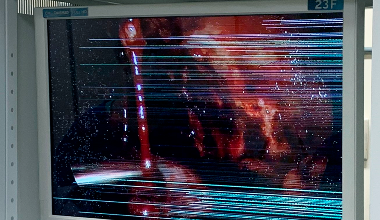 Como evitar interferências de imagem na Videocirurgia?